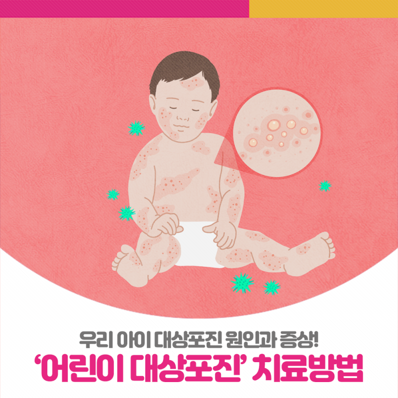 하단아동병원 우리 아이 대상포진 원인과 증상 네이버 블로그